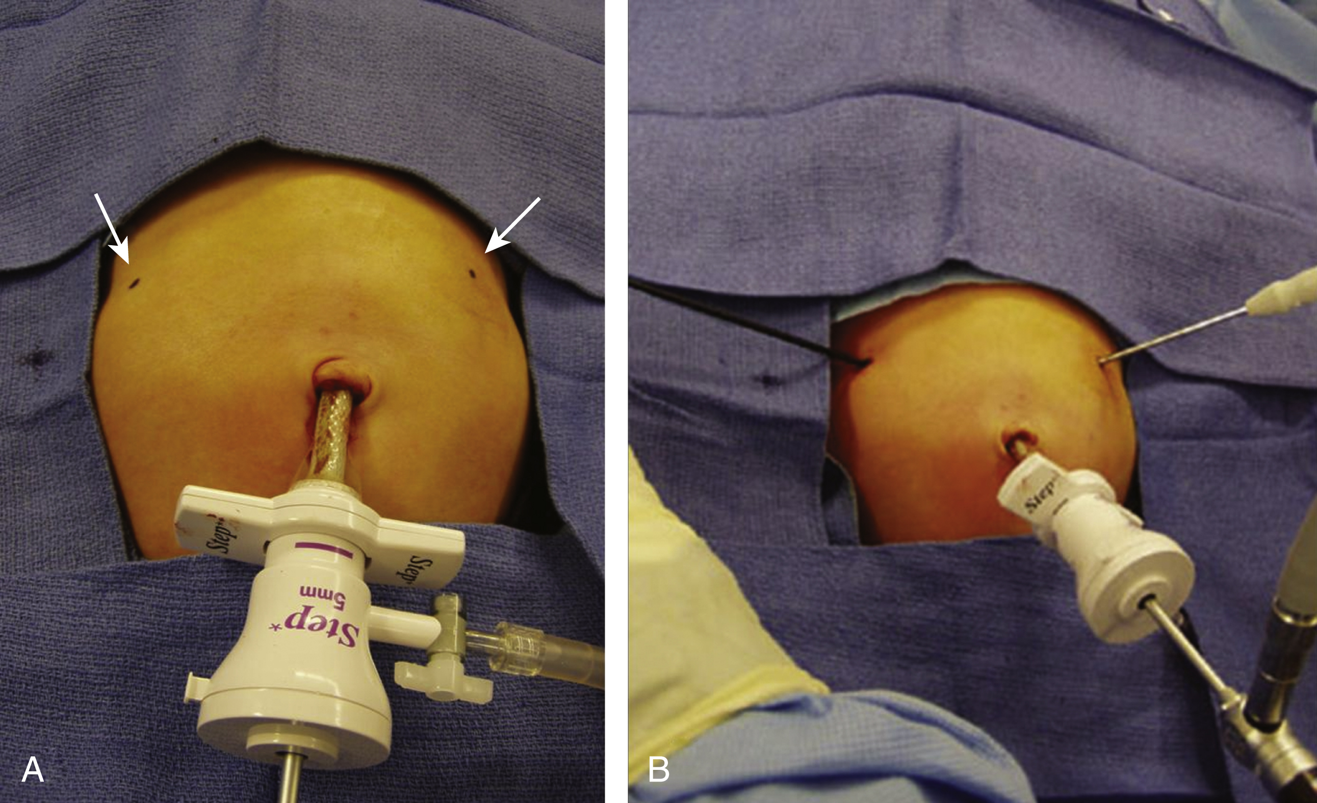 Laparoscopic Pyloromyotomy Abdominal Key
