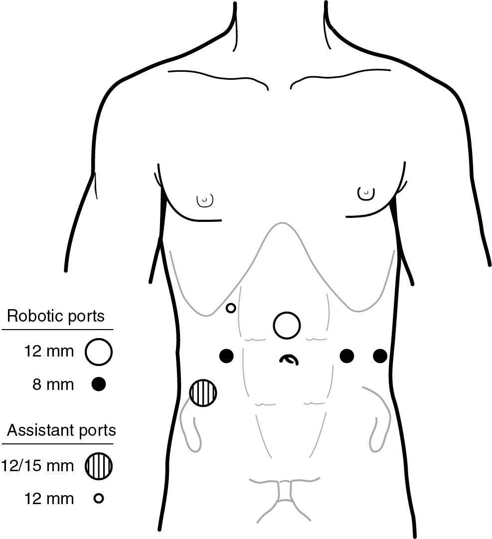 Robotic Assisted Radical Cystectomy Abdominal Key