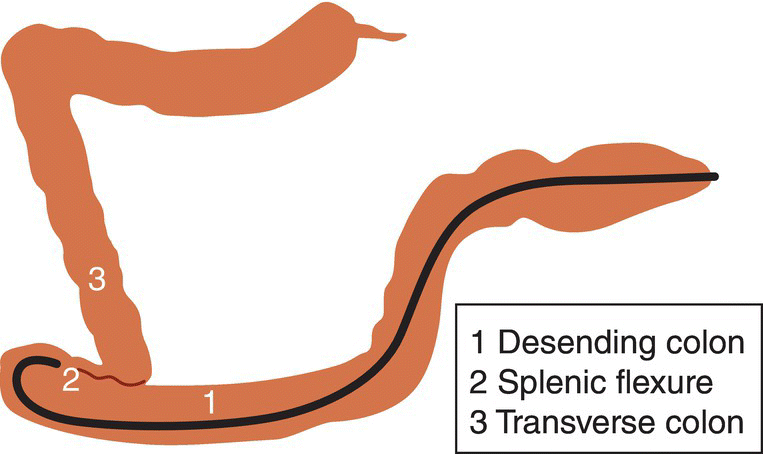 Pediatric Ileocolonoscopy Abdominal Key